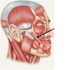 Zygomaticus Major Dimples